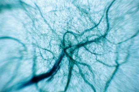 Crohnova choroba | Archiv článků